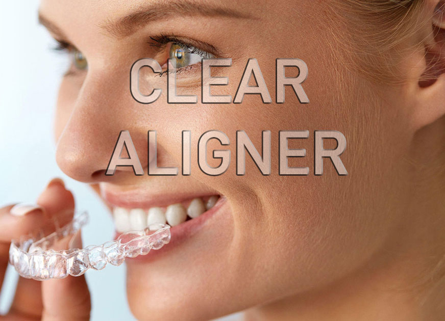 Clear Aligner - DentalApp Iran