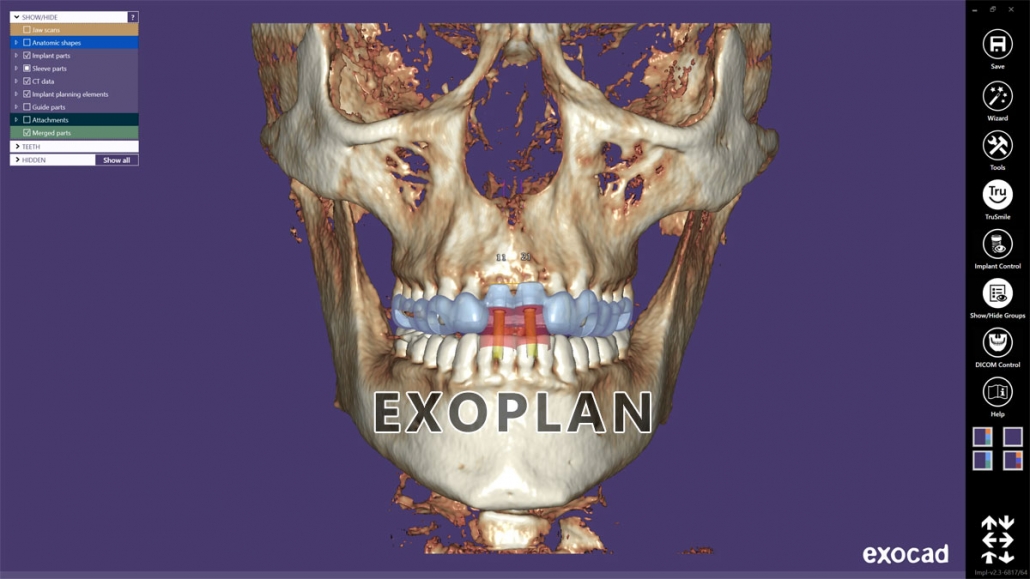 اگزوکد اگزوپلن - exocad ExoPlan - دنتال اپ ایران