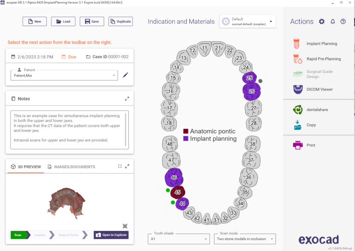 ExoPlan 3.1 - 2023 - دنتال اپ ایران