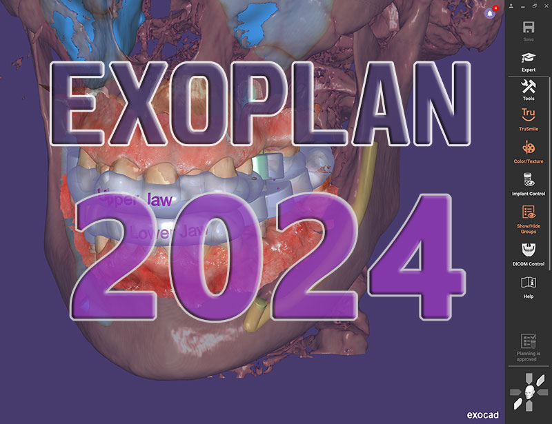 ExoPlan 3.1 - 2025 - دنتال اپ ایران